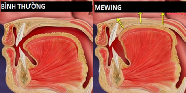 Mewing là gì? Những điều cần chú ý khi tập mewing?